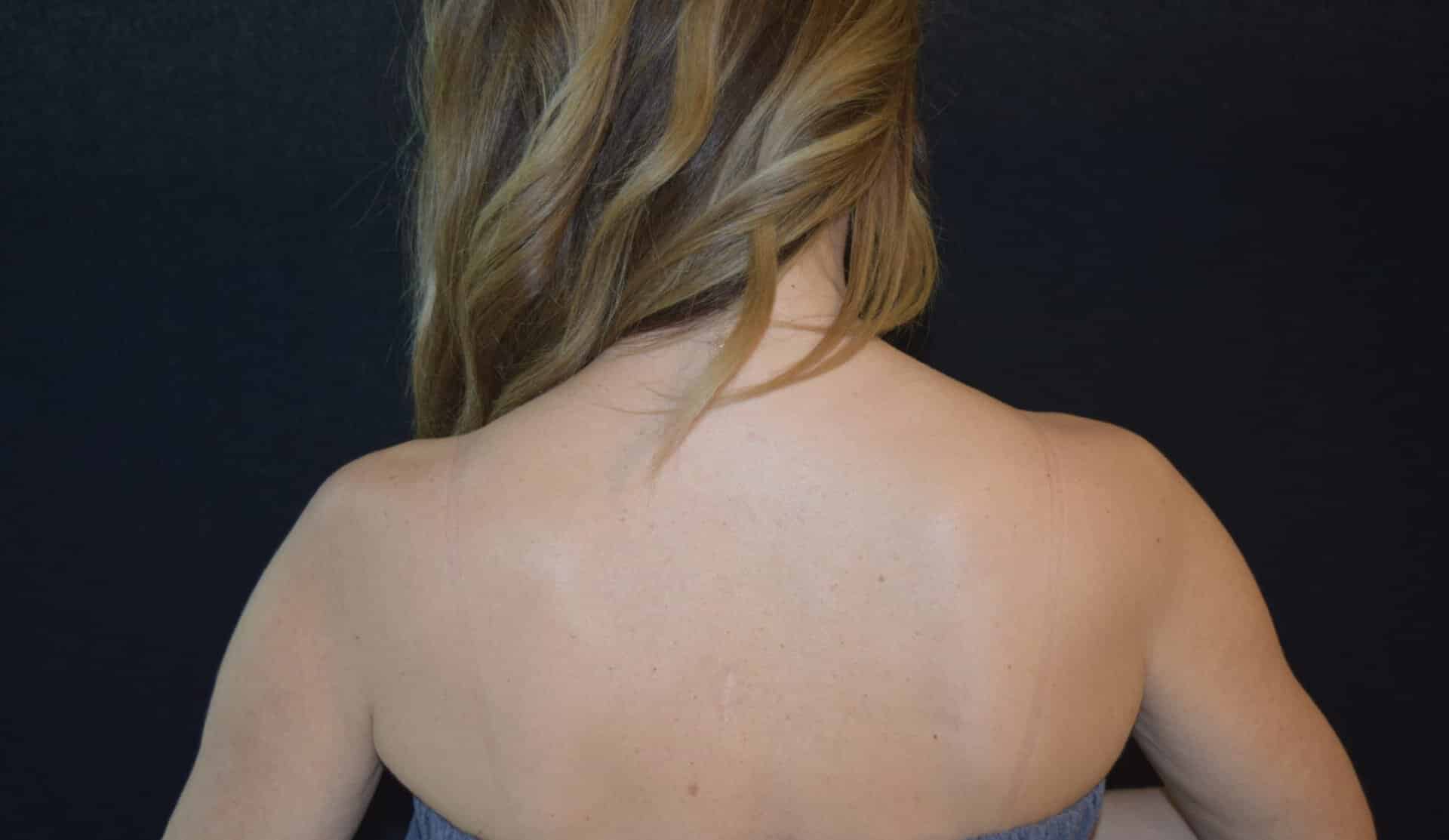 IPL Treatments For The Body | Saxon MD | Facial Plastic Surgeon Austin ...