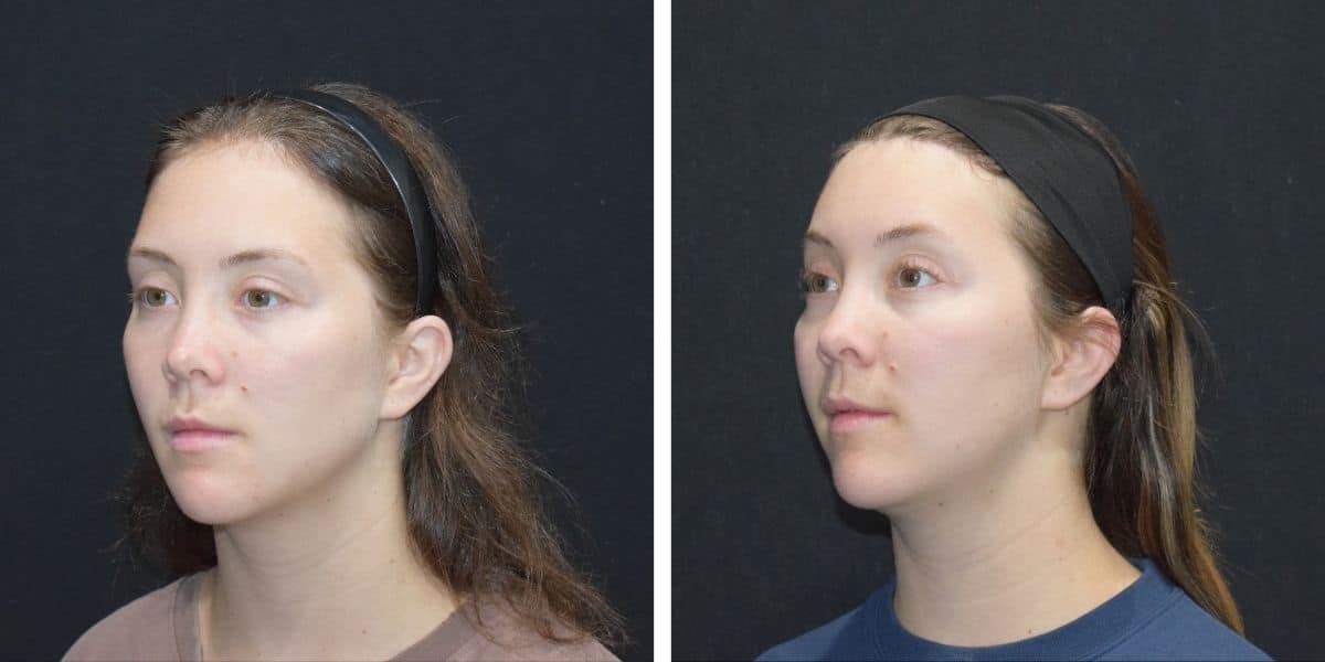 Brow Lift Before And After | Saxon MD | Austin & Dallas, TX