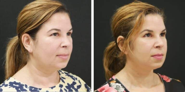 Buccal Fat Removal Before And After | Austin & Dallas, TX