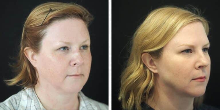 Buccal Fat Removal Before And After | Austin & Dallas, TX