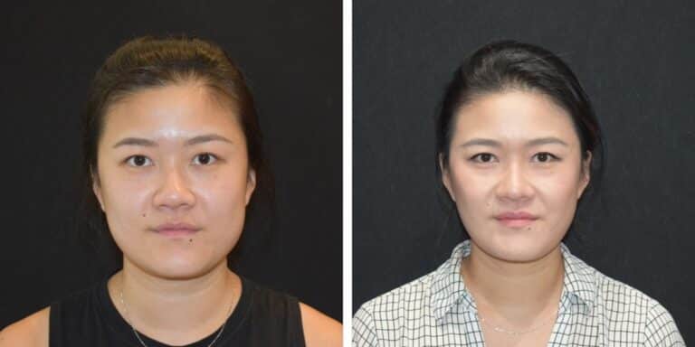 Buccal Fat Removal Before And After | Austin & Dallas, TX