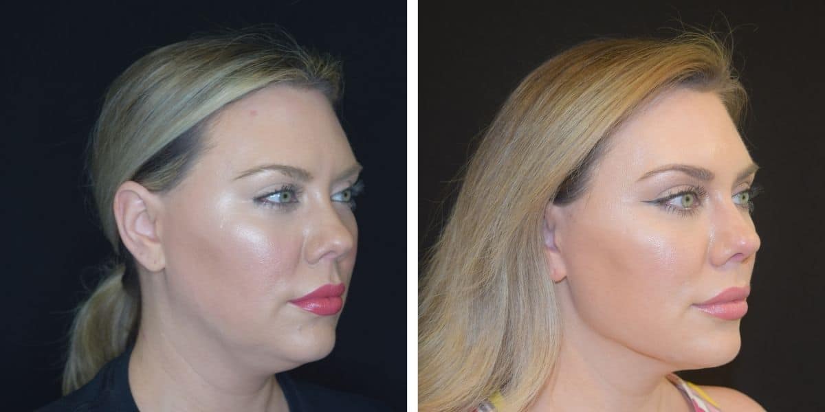 Embrace RF & Facetite Before And After | Austin & Dallas, TX