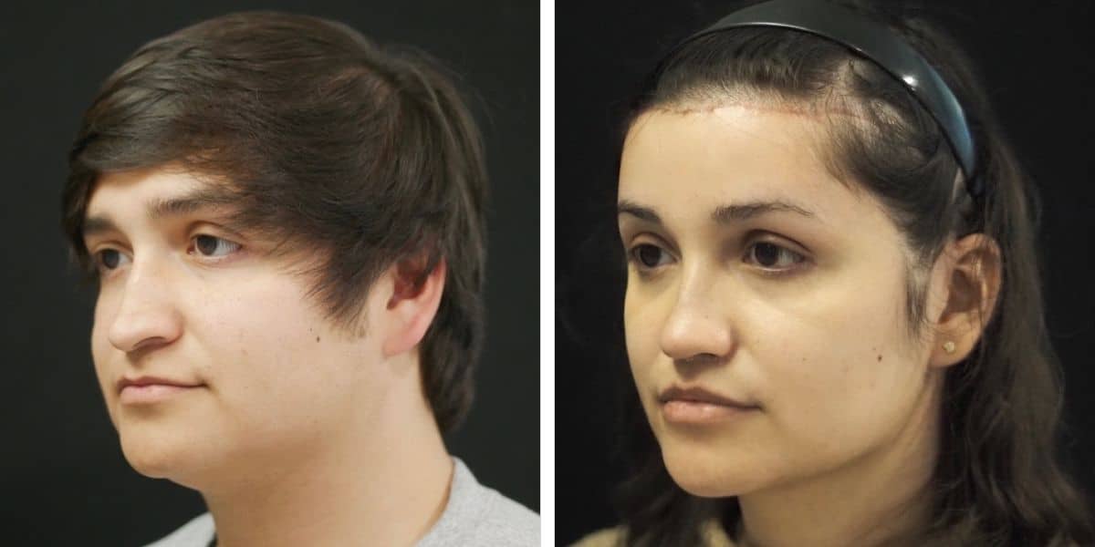 Best Facial Feminization Surgery (FFS) In Austin & Dallas