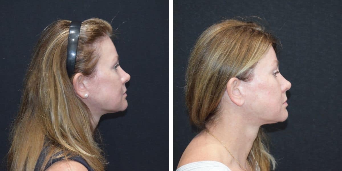 Facial Implants | Saxon MD | Austin And Dallas, TX