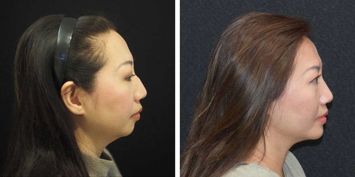 Facial Implants | Saxon MD | Austin And Dallas, TX