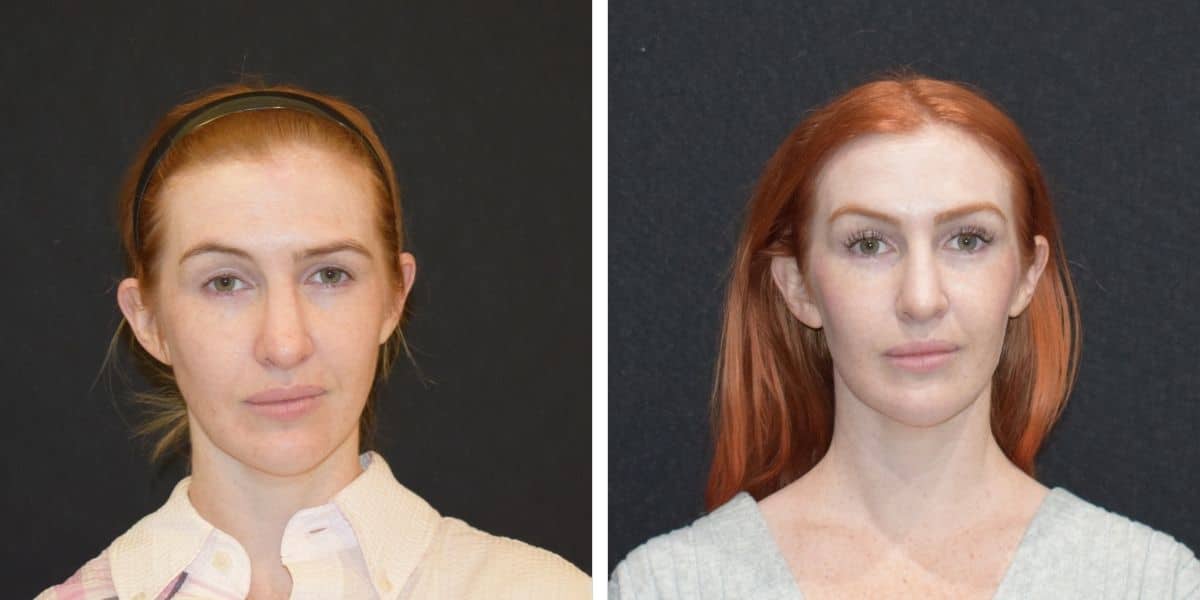 IPL Photofacial Before & After | Saxon MD | Austin, TX