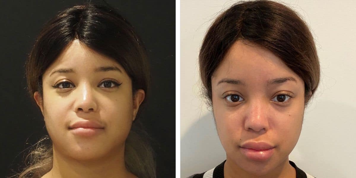 Jaw Contouring | Facial Plastic Surgery Austin & Dallas, TX