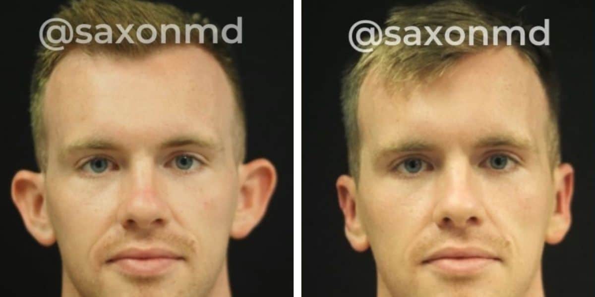 Otoplasty Before And After | Saxon MD | Austin & Dallas, TX