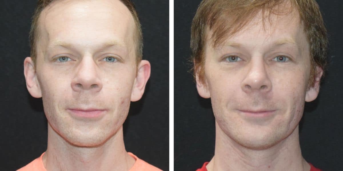 Otoplasty Before And After | Saxon MD | Austin & Dallas, TX