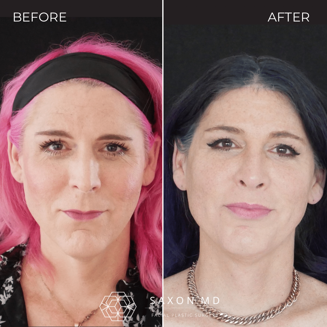 Best Facial Feminization Surgery (FFS) In Austin & Dallas