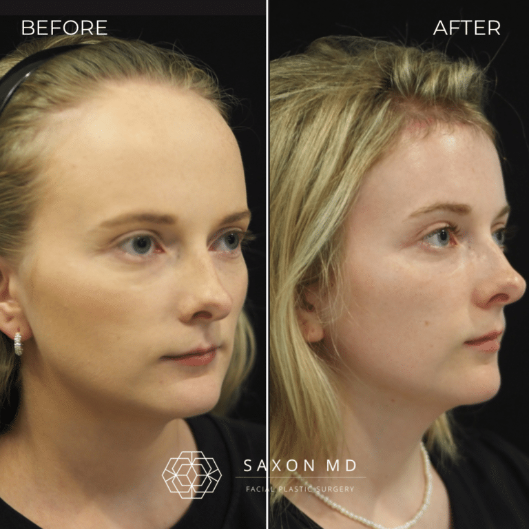 Forehead Reduction Surgery Before And After