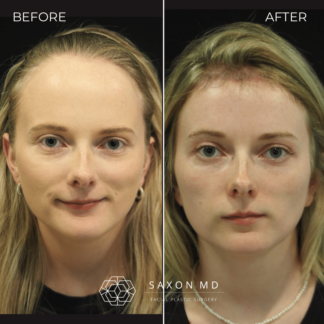 Forehead Reduction Surgery Before And After