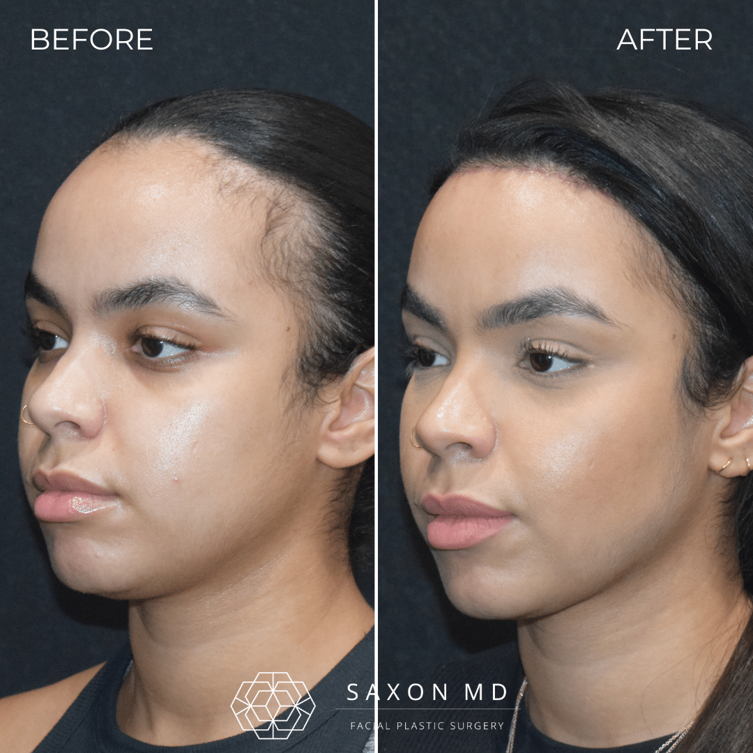 How To Get A Smaller Forehead | Dr. Sarah Saxon