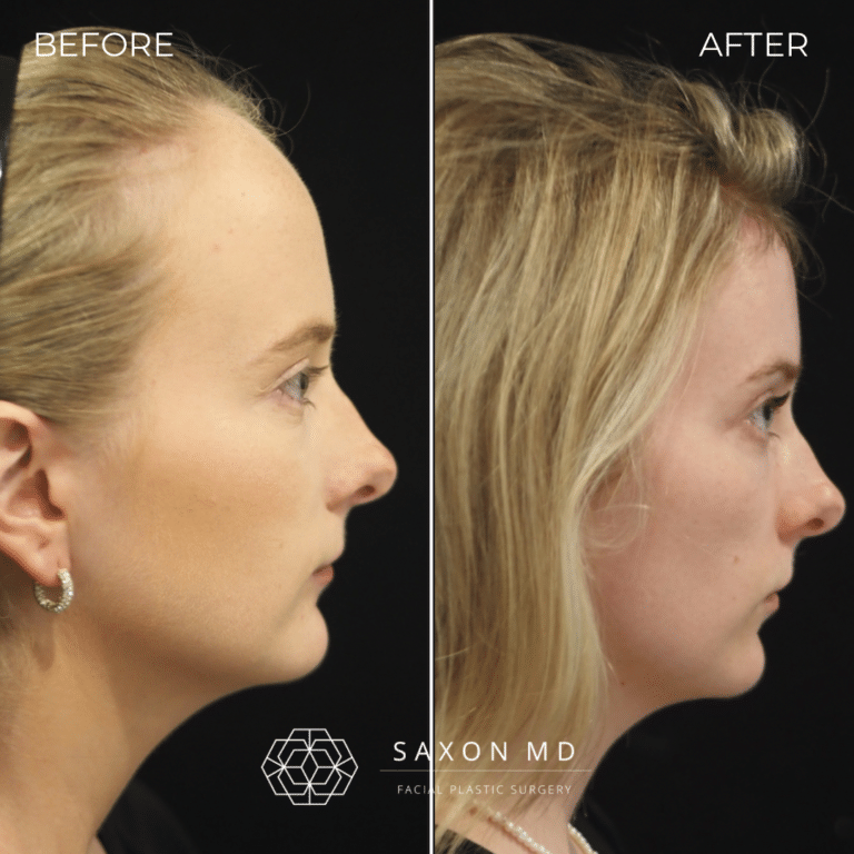 Forehead Reduction Surgery Before And After