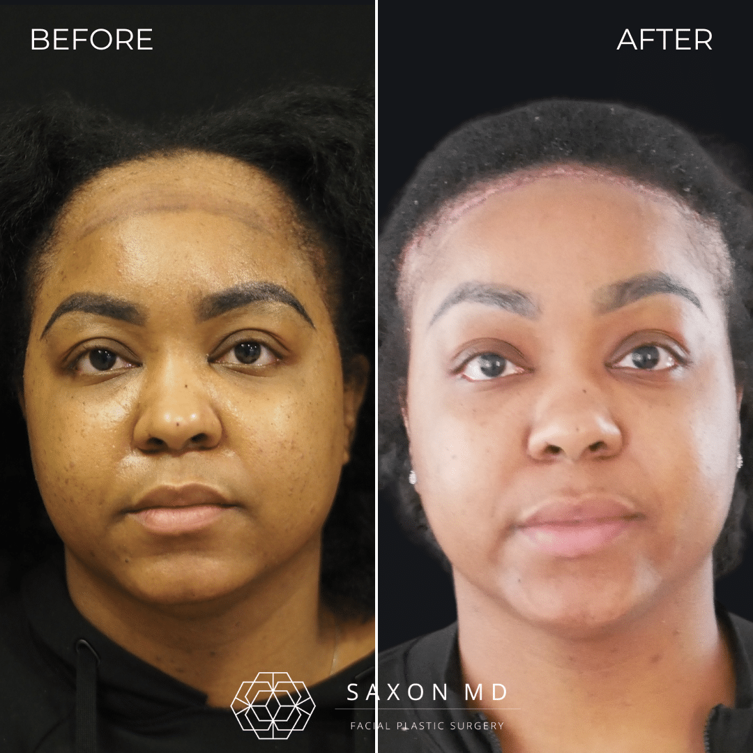 Forehead Reduction Surgery Before And After