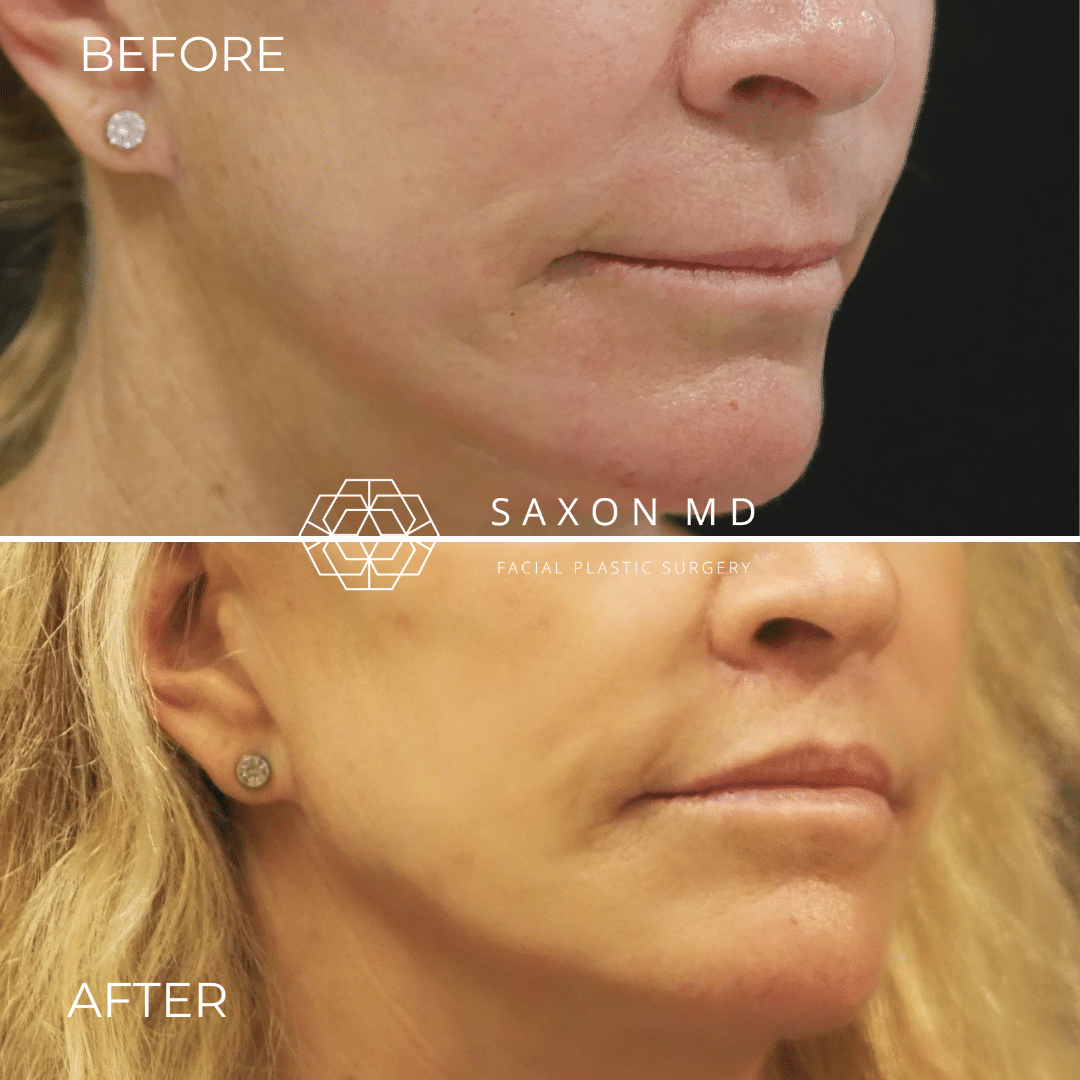 Lip Lift Before And After Photos | Austin And Dallas, TX