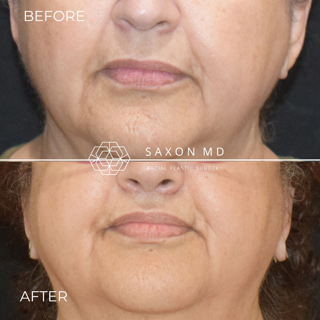 What Is A Corner Lip Lift | Dr. Sarah Saxon