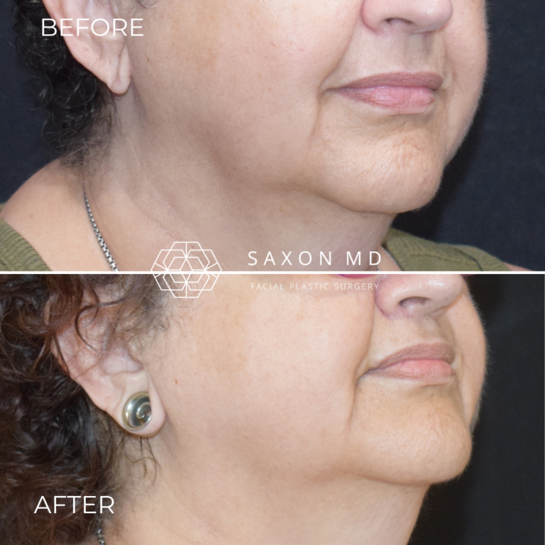 Lip Lift Before And After Photos | Austin And Dallas, TX