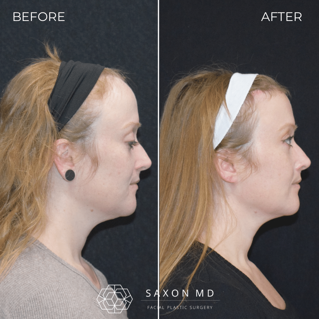 Forehead Reduction Surgery Before And After