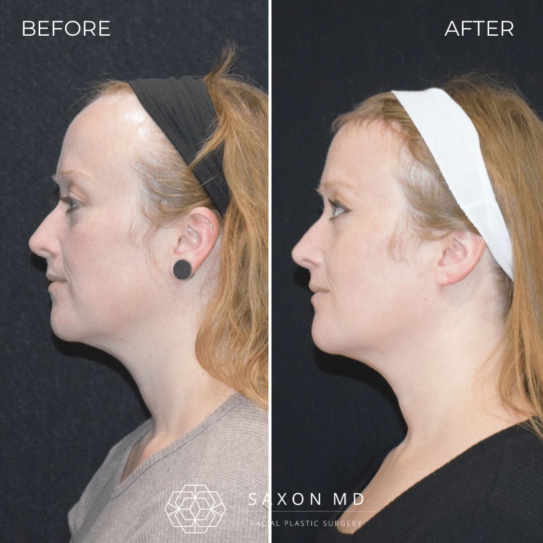 Forehead Reduction Surgery Before And After