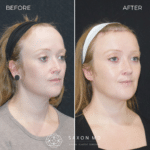 Forehead Reduction Surgery Before And After
