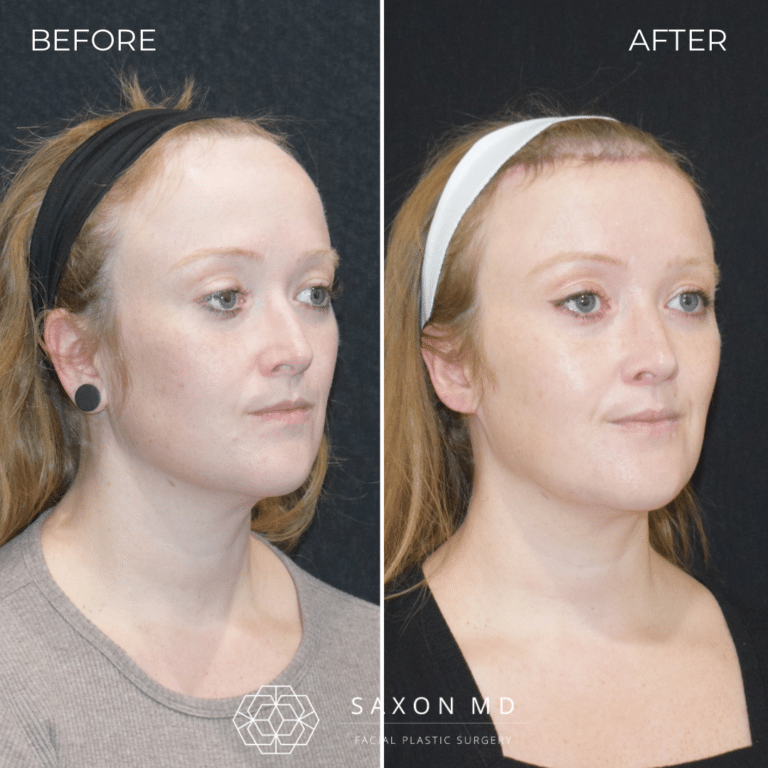 Forehead Reduction Surgery Before And After
