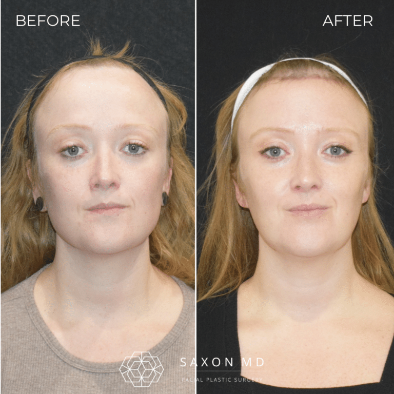 Forehead Reduction Surgery Before And After