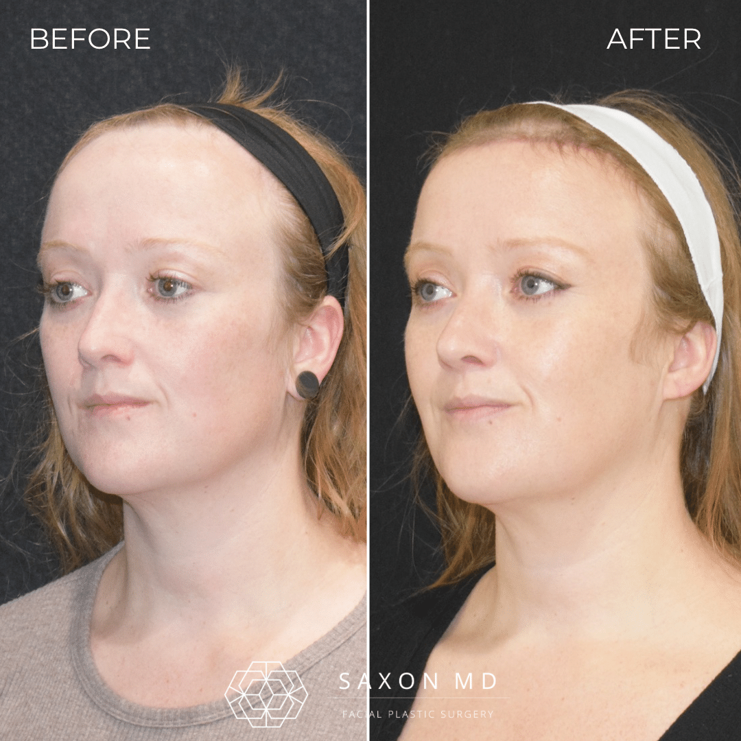 Forehead Reduction Surgery Before And After