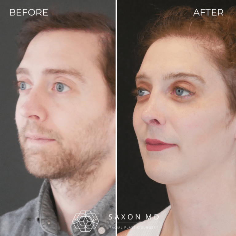 Best Facial Feminization Surgery (FFS) In Austin & Dallas