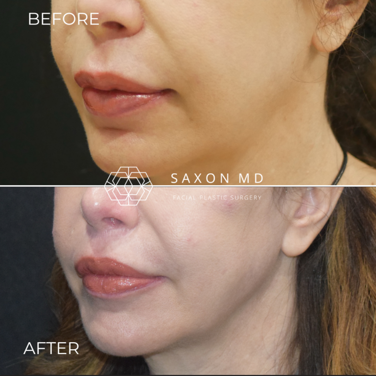 Lip Lift Before And After Photos | Austin And Dallas, TX