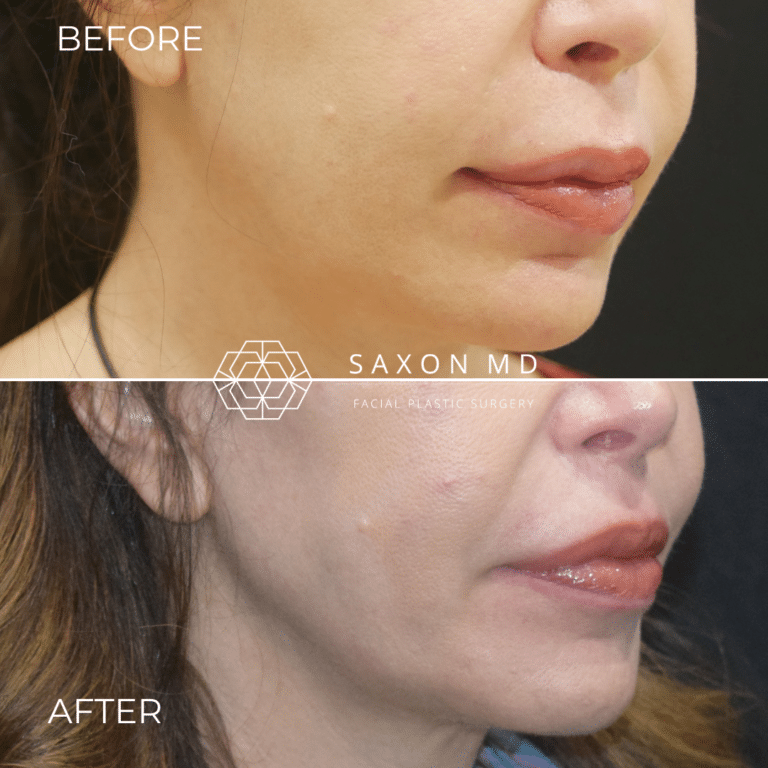 Lip Lift Before And After Photos | Austin And Dallas, TX