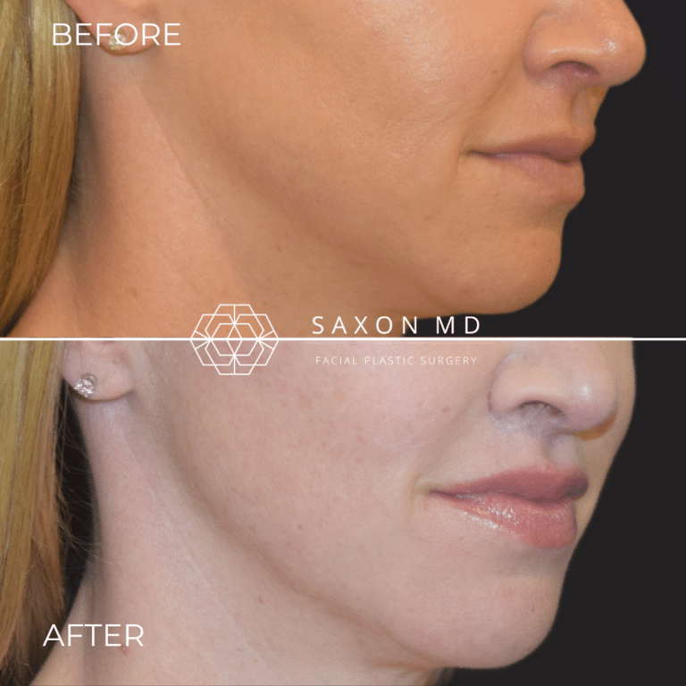 Lip Lift Before And After Photos | Austin And Dallas, TX