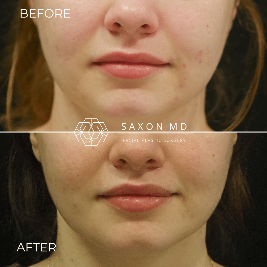 Lip Lift Before And After Photos | Austin And Dallas, TX