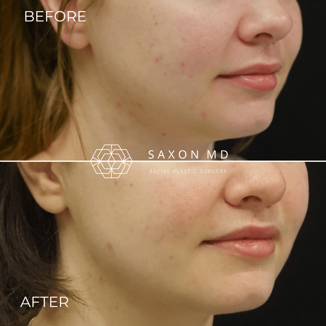 Lip Lift Before And After Photos | Austin And Dallas, TX