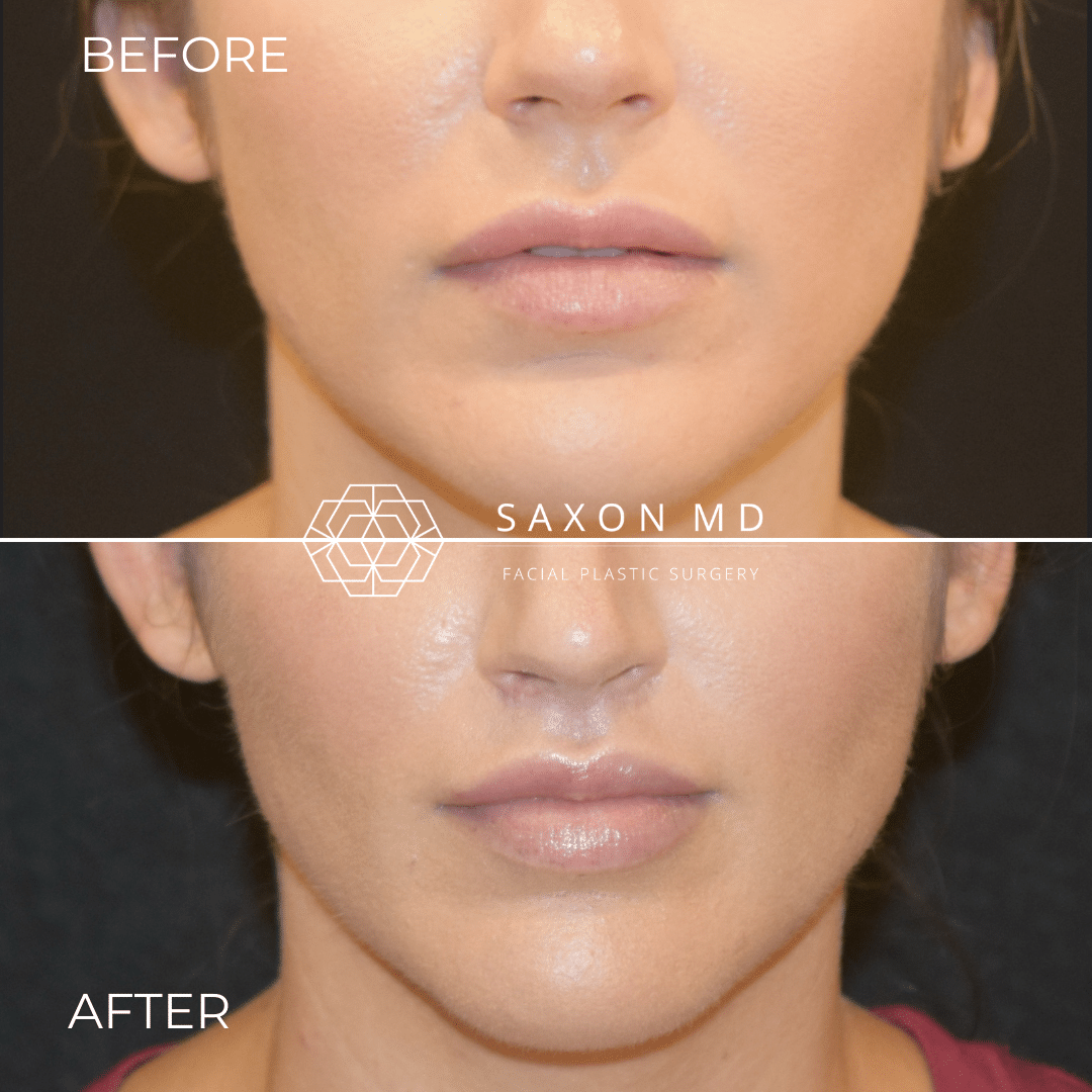 Lip Lift Before And After Photos Austin And Dallas Tx