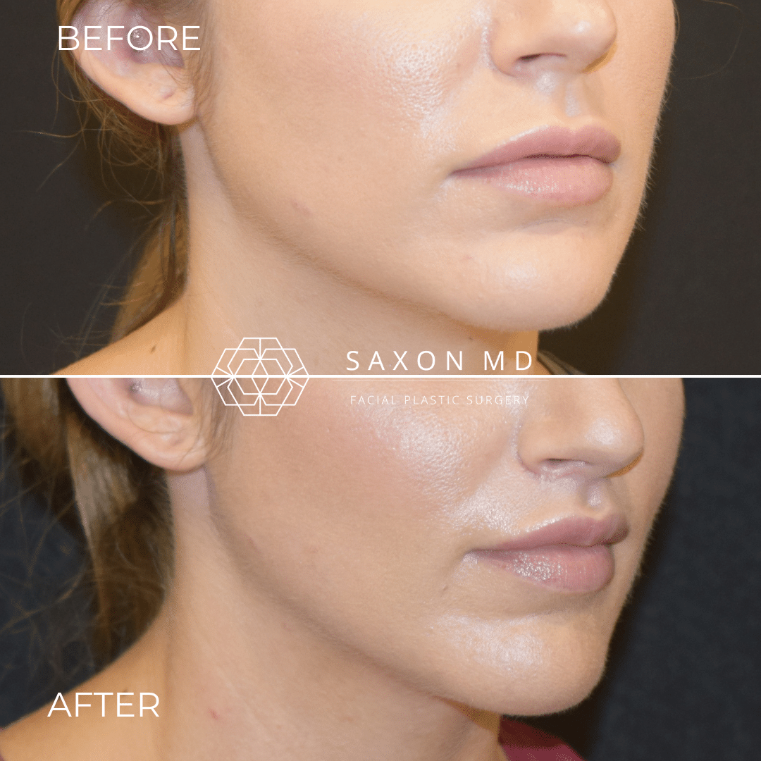 Lip Lift Before And After Photos | Austin And Dallas, TX