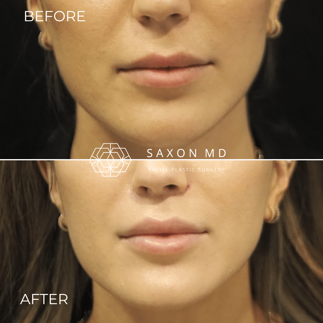 Lip Lift Before And After Photos Austin And Dallas Tx