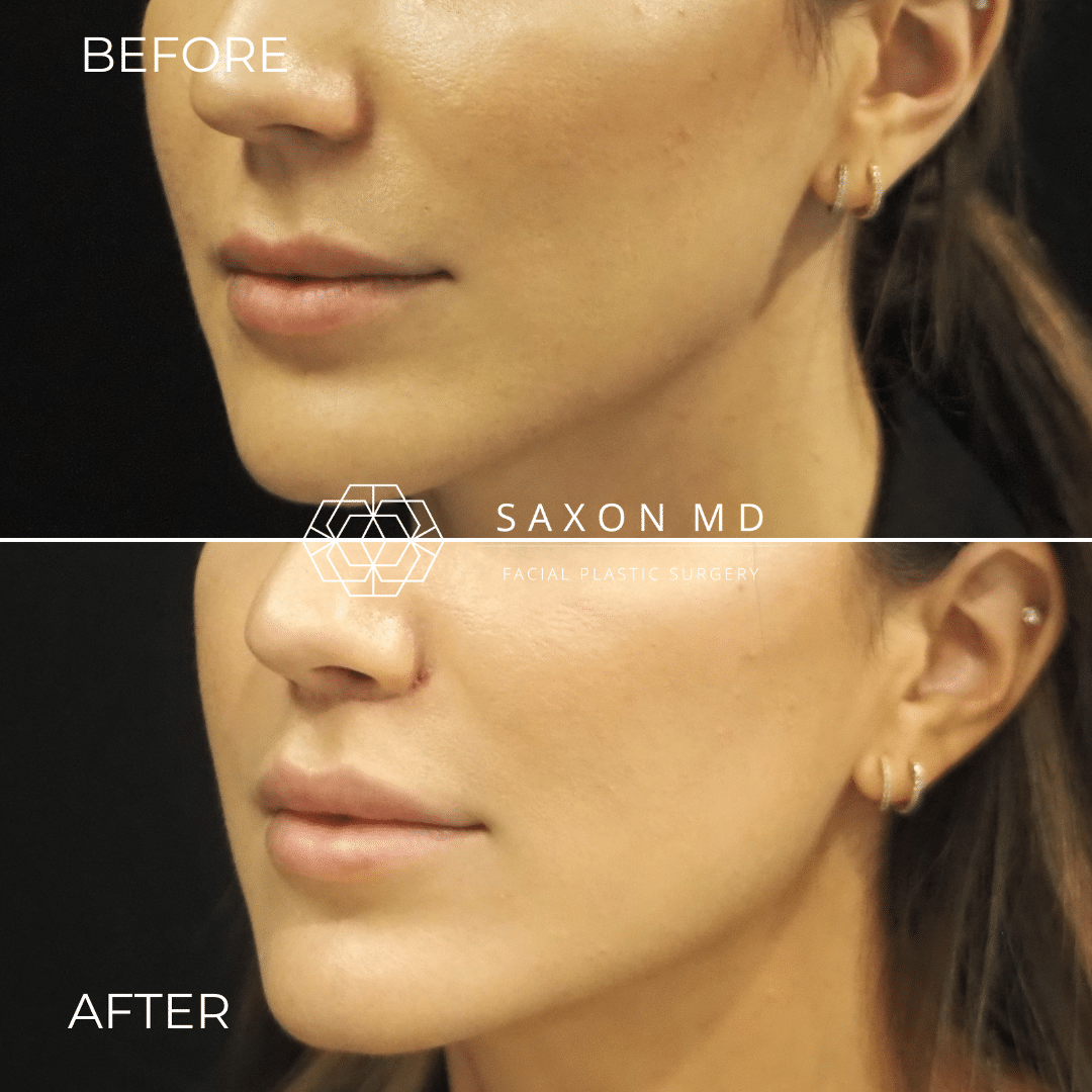 Lip Lift Before And After Photos | Austin And Dallas, TX