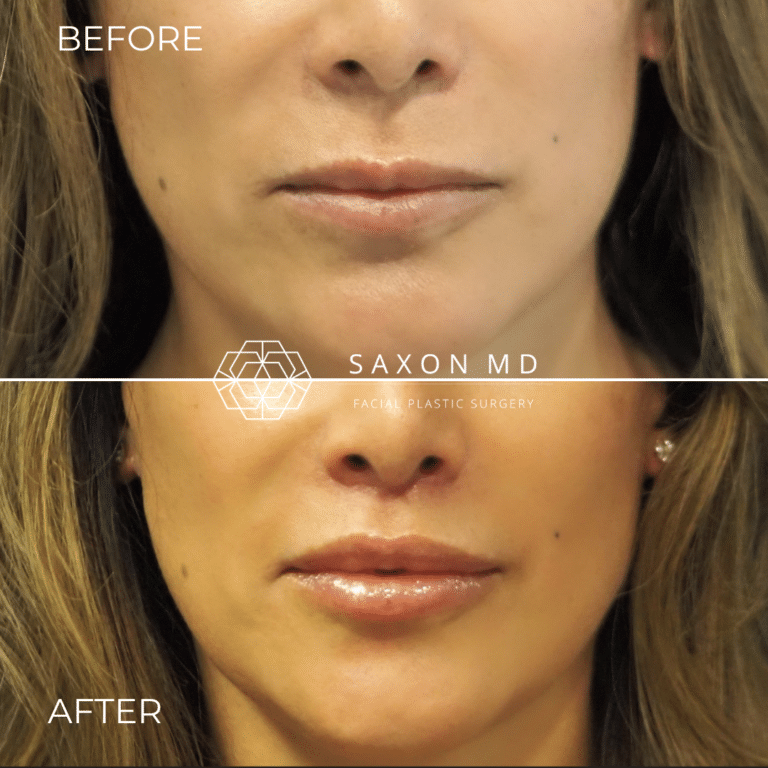 Lip Lift Before And After Photos | Austin And Dallas, TX