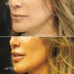 Lip Lift Before And After Photos | Austin And Dallas, TX