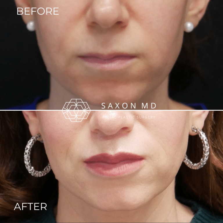 Lip Lift Before And After Photos | Austin And Dallas, TX