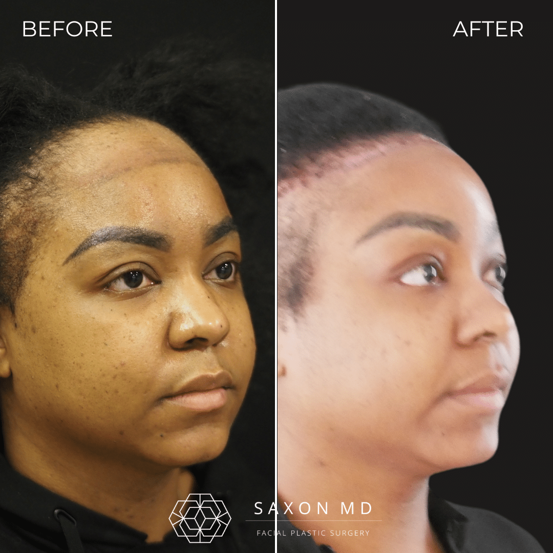 Forehead Reduction Surgery Before And After