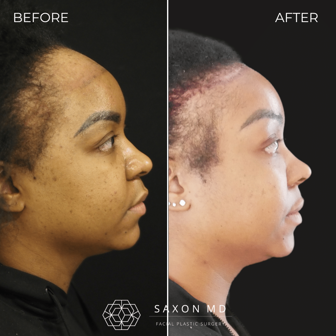 Forehead Reduction Surgery Before And After