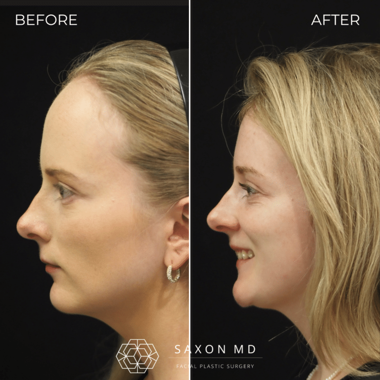 Forehead Reduction Surgery Before And After