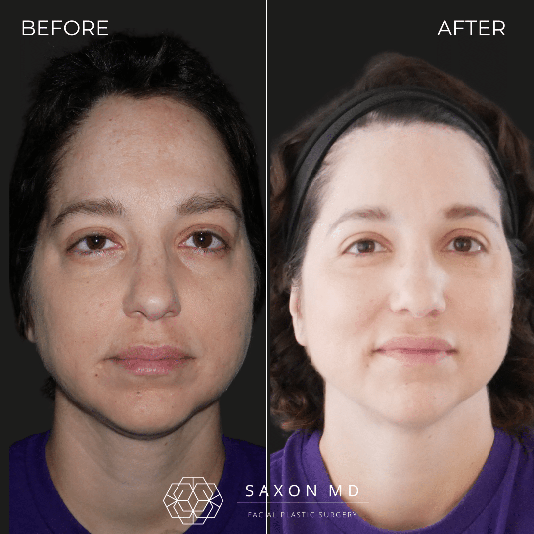 Forehead Reduction Surgery Before And After