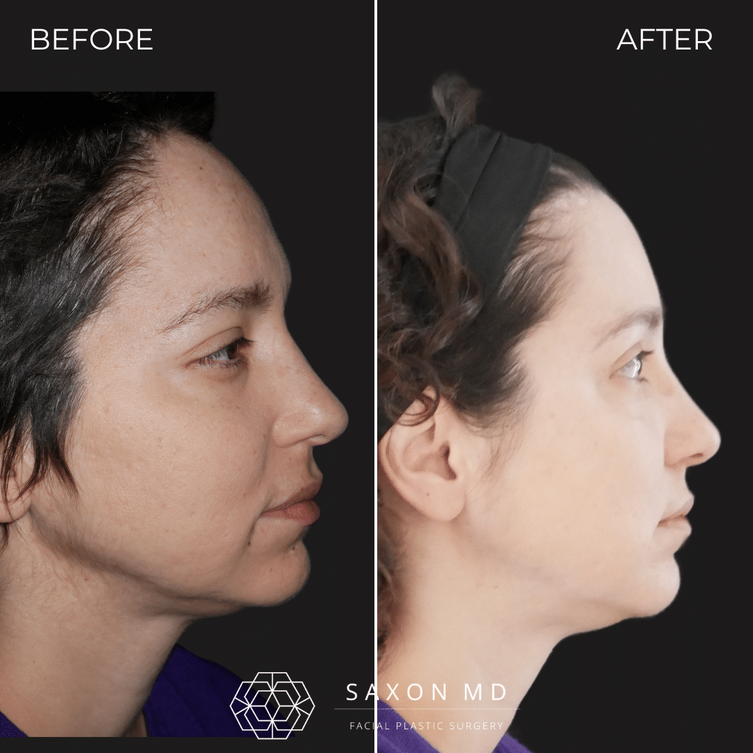 Forehead Reduction Surgery Before And After