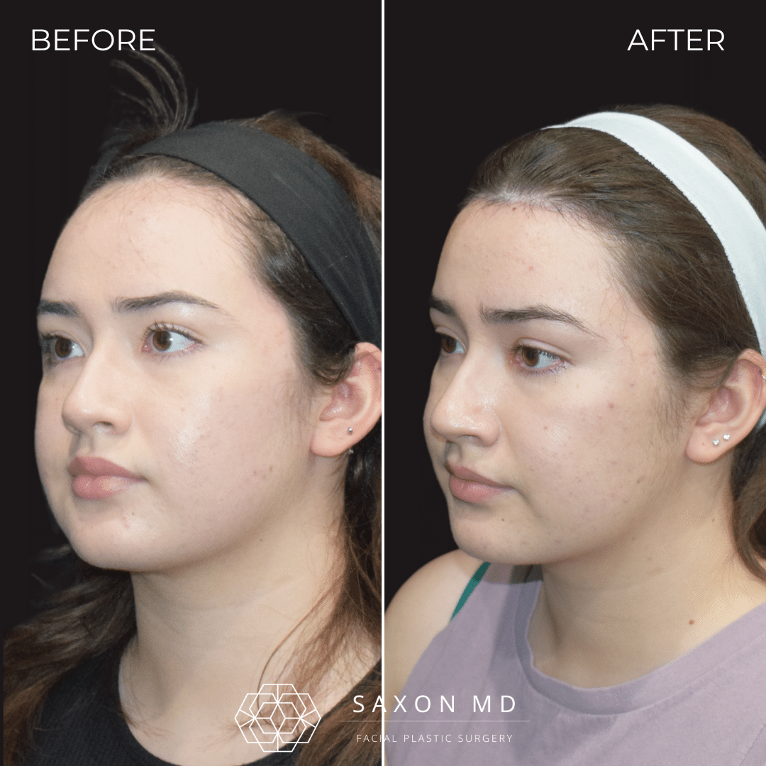 Hairline Lowering | Forehead Reduction | Austin & Dallas, TX