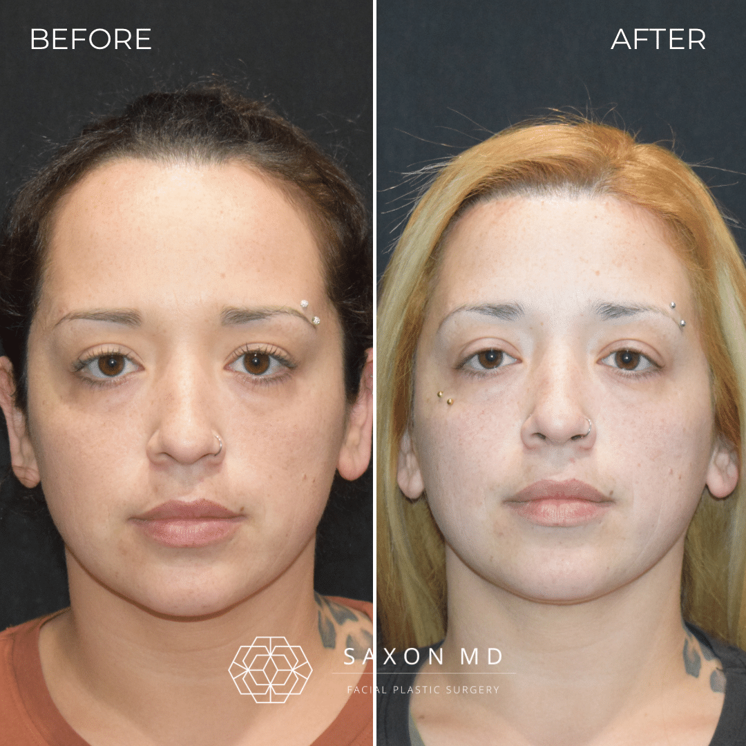 Forehead Reduction Surgery Before And After