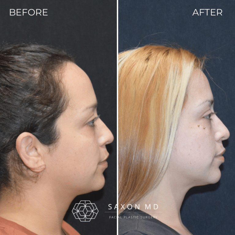 Forehead Reduction Surgery Before And After