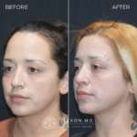 Forehead Reduction Surgery Before And After